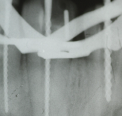 Management of the open apex : Ireland's Dental Magazine