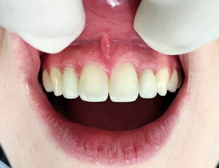 Dental implants in the aesthetic zone : Ireland's Dental Magazine