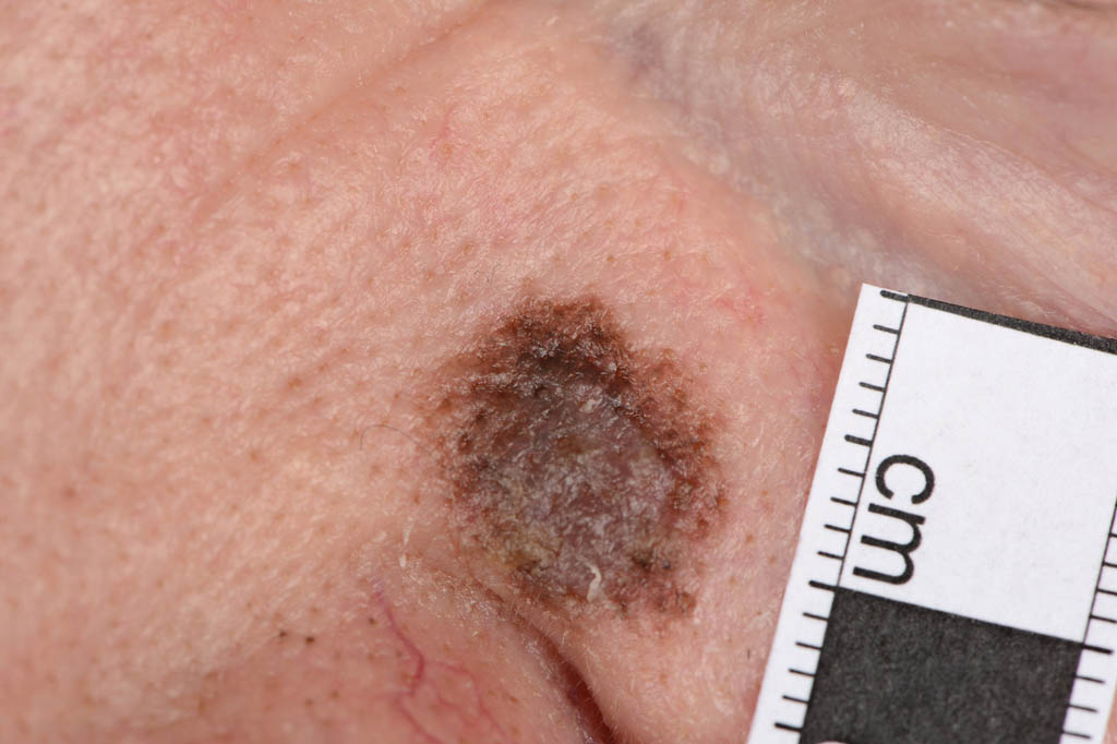 Recognition of head and neck skin cancer: A guide for GDPs : Ireland's ...