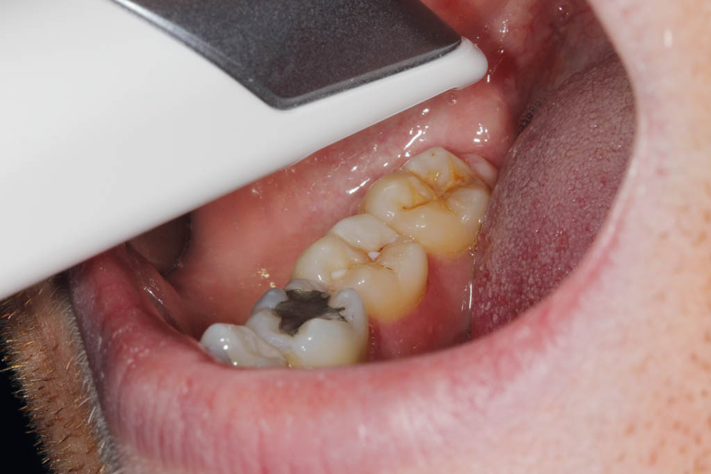 Intraoral scanners in dentistry – an update on digital technology ...