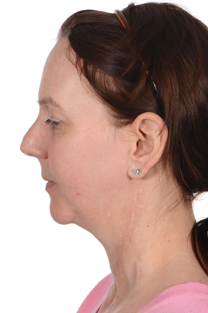 First bite syndrome: What every general dental practitioner should know ...