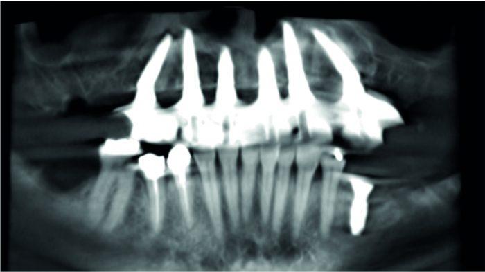 Upper arch rehabilitation using dental implants : Ireland's Dental Magazine