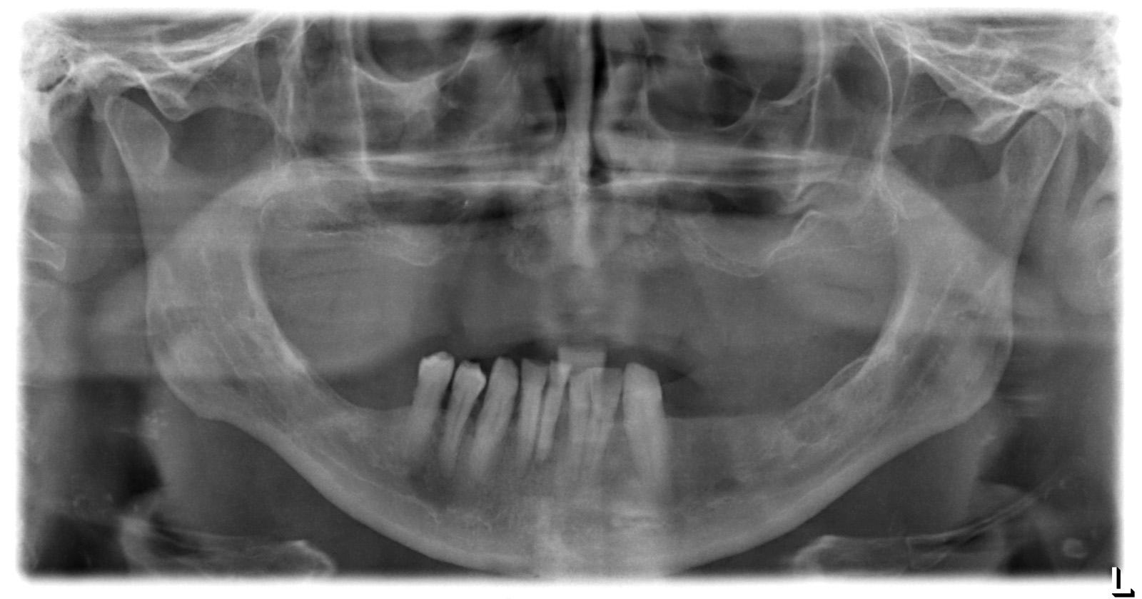 Minimally invasive treatment options in the atrophied bone: The Bone ...