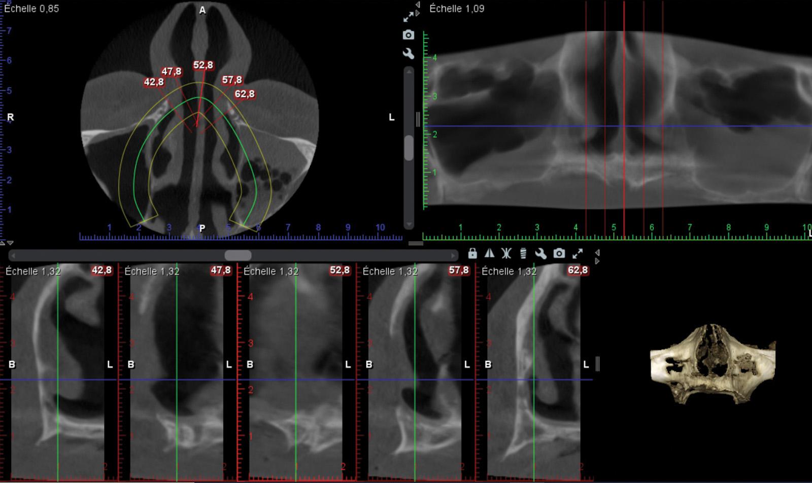 Minimally invasive treatment options in the atrophied bone: The Bone ...