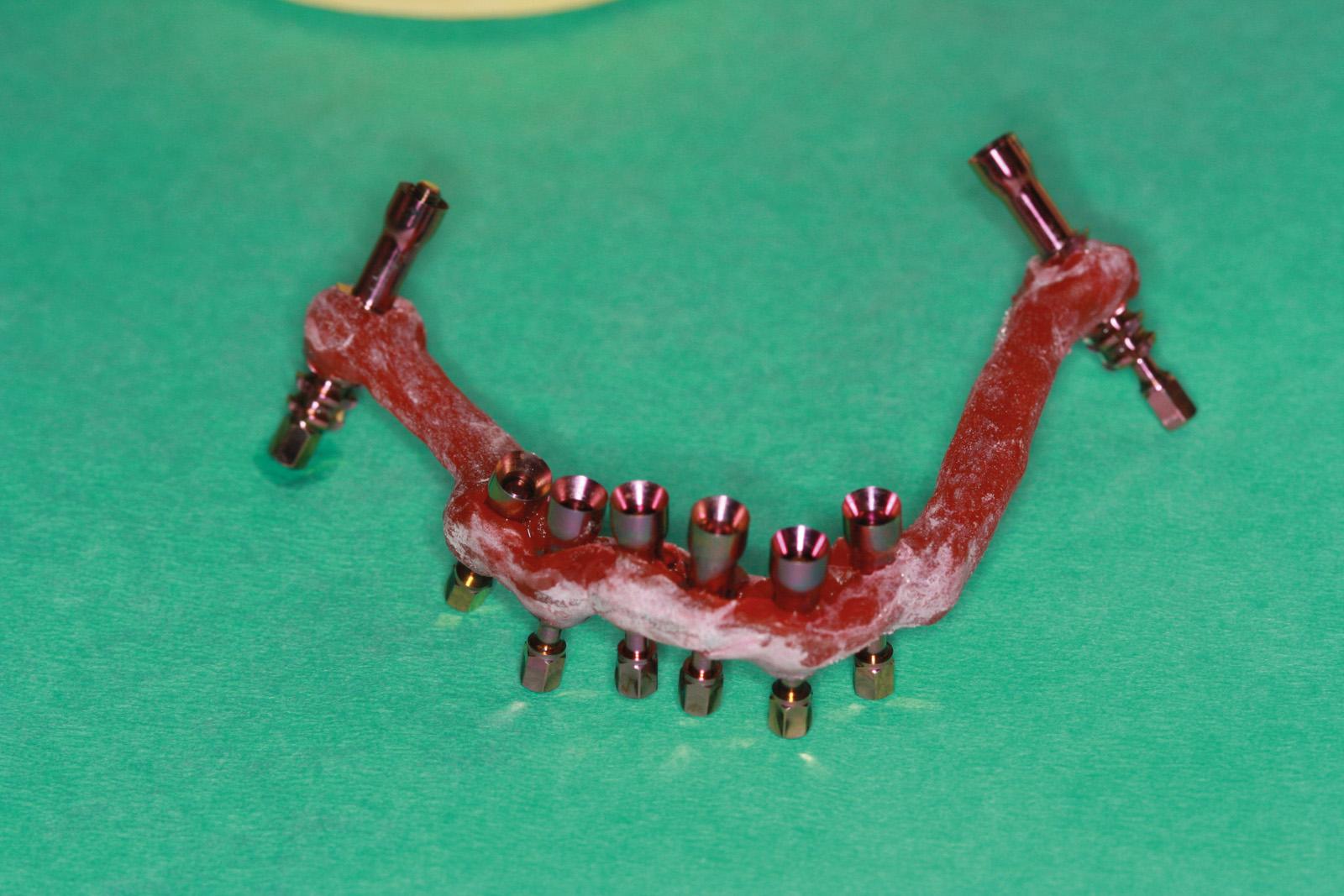 Minimally invasive treatment options in the atrophied bone: The Bone ...